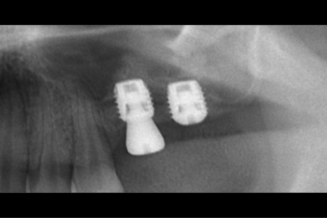 Crestal Sinus Floor Elevation - Geistlich Pharma AG