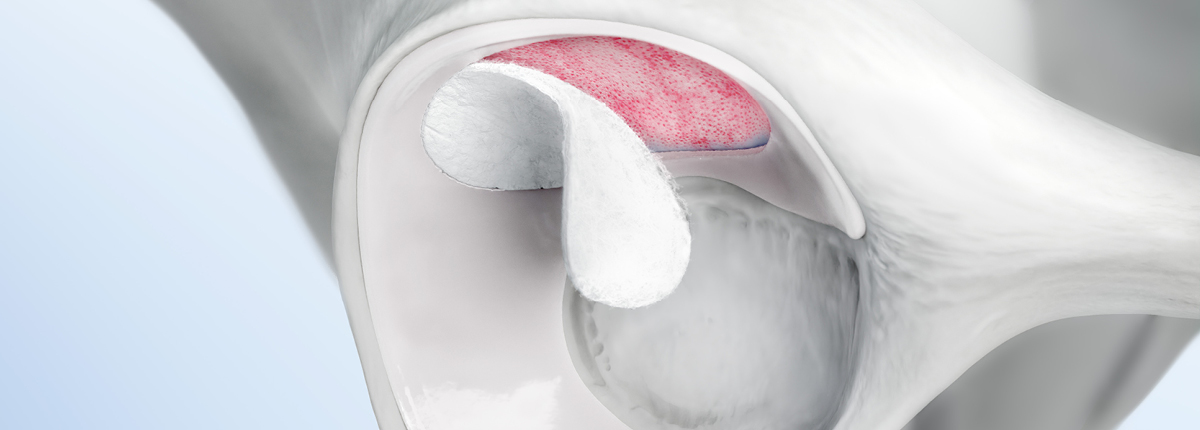 AMIC Hip - Geistlich Pharma AG