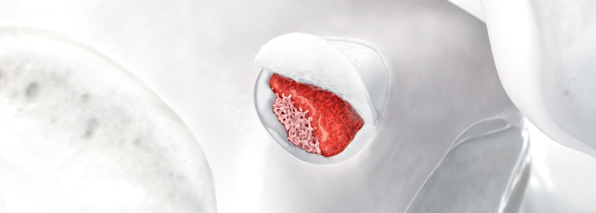 AMIC Talus - Geistlich Pharma AG