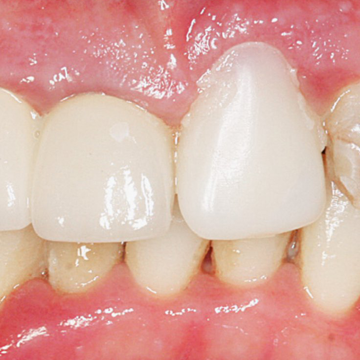 Ridge Preservation in socket with preserved buccal bone wall ...