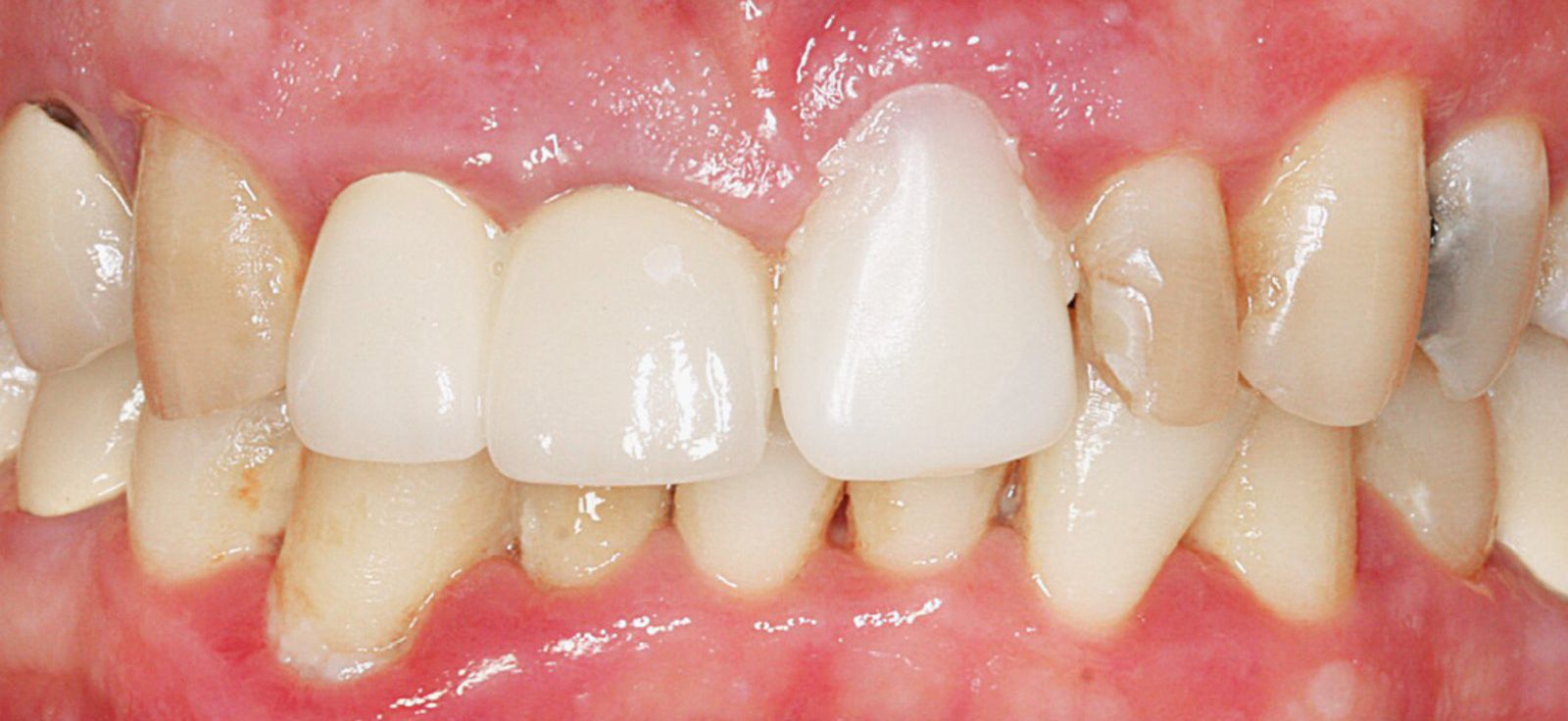 Ridge Preservation in socket with preserved buccal bone wall ...