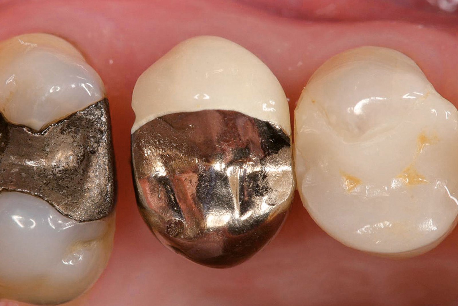 Ridge Preservation with scar-free soft tissue healing - Geistlich Pharma AG