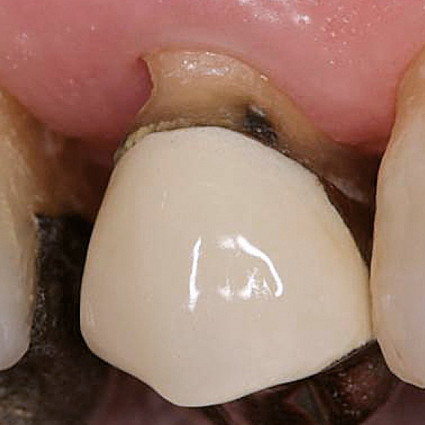 Ridge Preservation with scar-free soft tissue healing - Geistlich Pharma AG