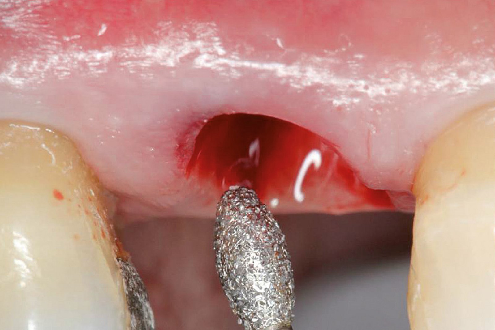 Ridge Preservation with scar-free soft tissue healing - Geistlich Pharma AG