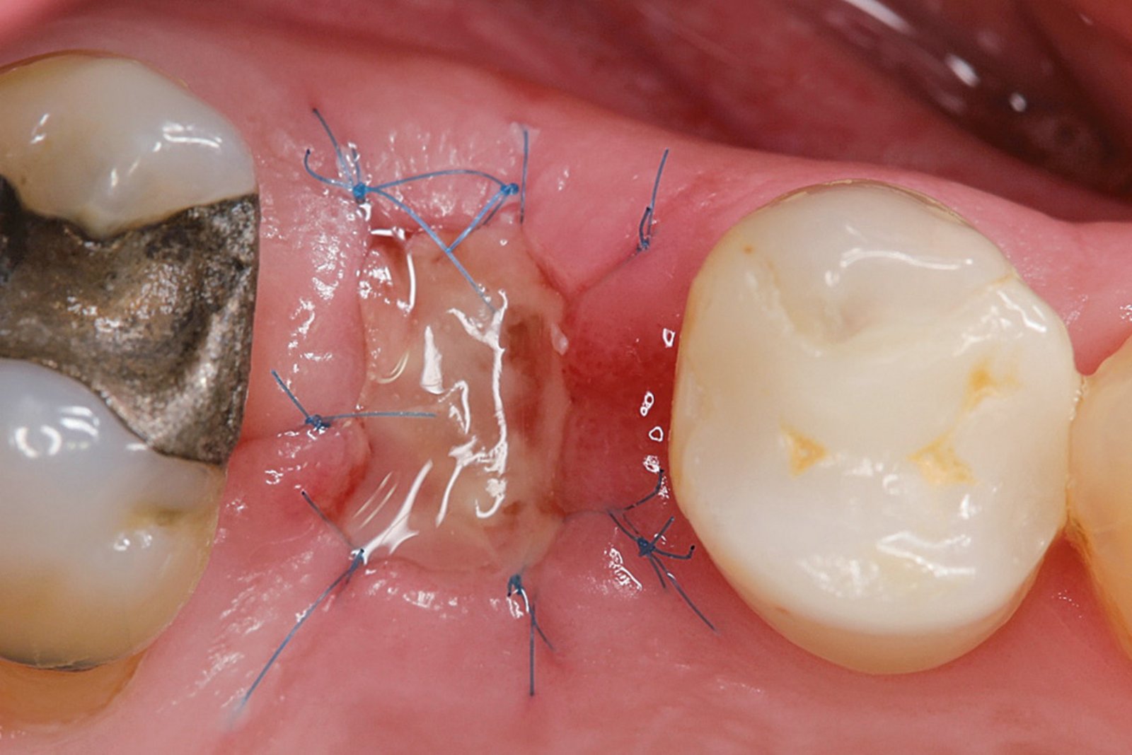 Ridge Preservation with scar-free soft tissue healing - Geistlich Pharma AG
