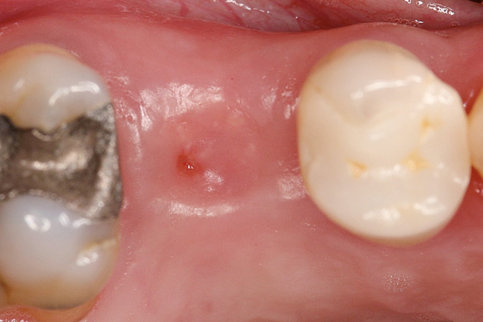 Ridge Preservation with scar-free soft tissue healing - Geistlich Pharma AG