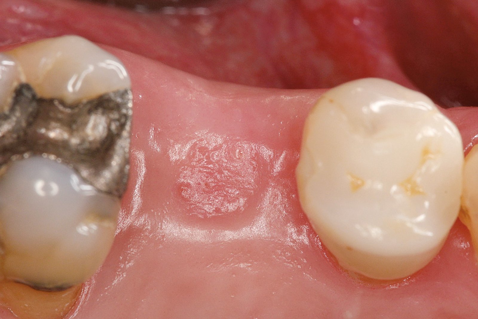 Ridge Preservation with scar-free soft tissue healing - Geistlich Pharma AG