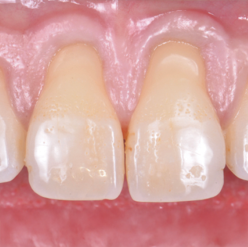 Multiple recession coverage in the anterior maxilla - Geistlich Pharma AG